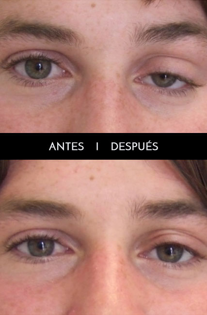 Caída del parpado superior - Vistacare